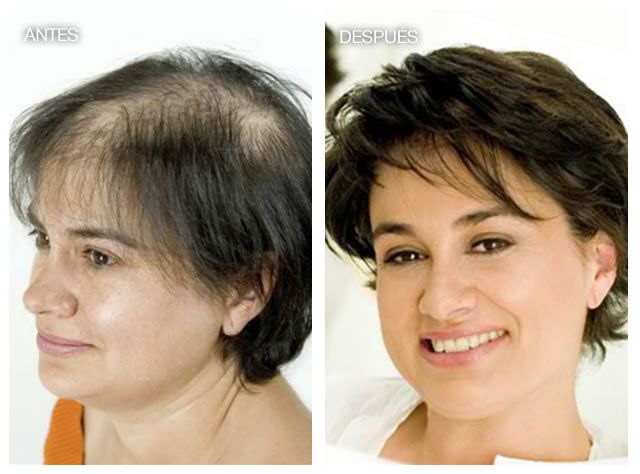 Disimular La Alopecia Femenina Y Calvicie En Mujeres Disimular La Alopecia Femenina Y Calvicie En Mujeres